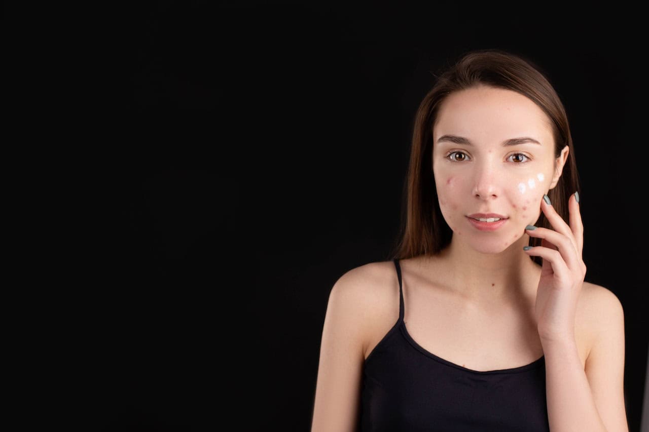 Transform Your Skin with Dead Sea Mud: Does it Really Help Acne Scars ...